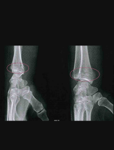 Fracture du poignet | Institut aquitain de la main Bordeaux