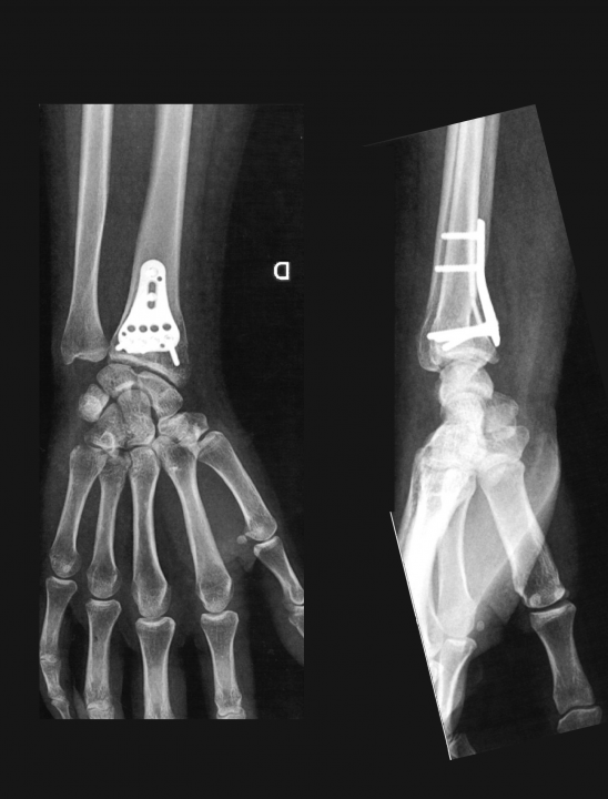 Fracture du poignet | Institut aquitain de la main Bordeaux