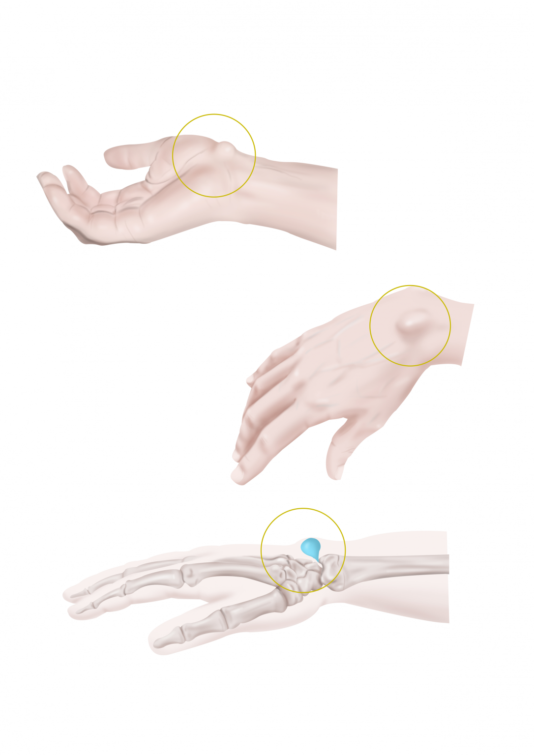 Kyste synovial au poignet | Institut Aquitain Main Bordeaux