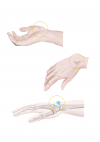 Kyste synovial au poignet | Institut Aquitain Main Bordeaux