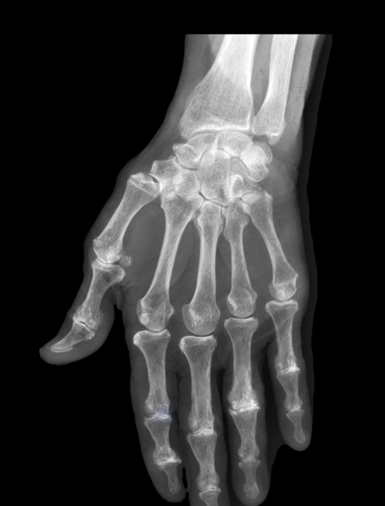 Arthrose du poignet | Institut de la main Bordeaux