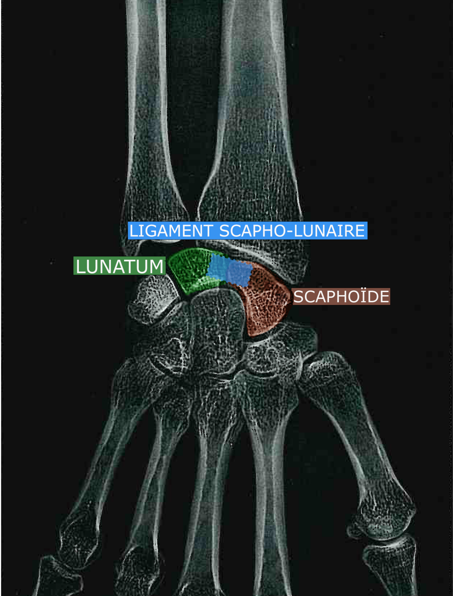 Rupture du ligament scapho-lunaire | Institut de la main Bordeaux