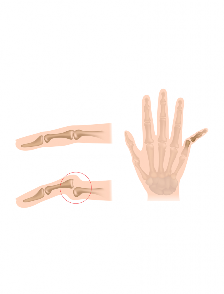 Luxation de doigt à Bordeaux | Institut aquitain de la main