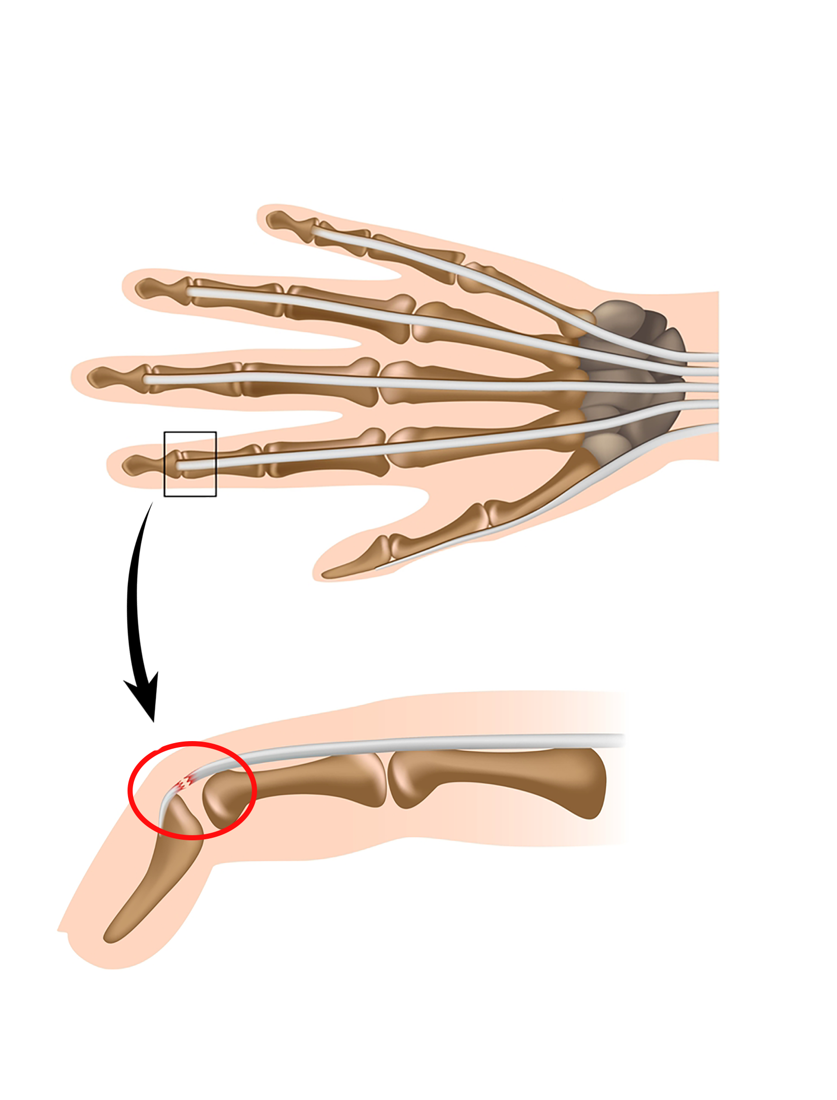 Mallet finger ou doigt en maillet | Institut Aquitain Main