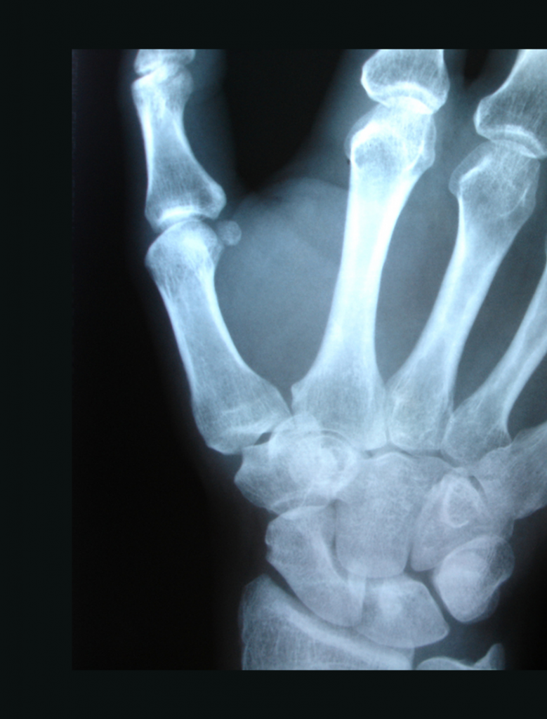 Rhizarthrose ou arthrose du pouce | Institut Aquitain Main