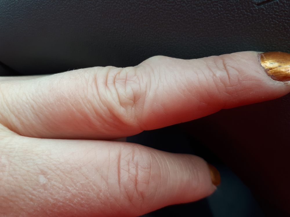 Kystes de la main Bordeaux - Institut Aquitain De La Main