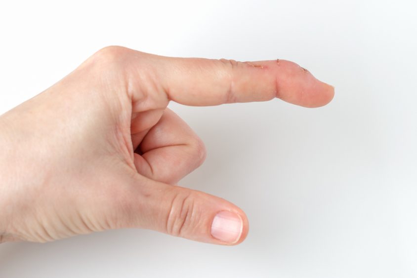 Mallet finger ou doigt en maillet | Institut Aquitain Main