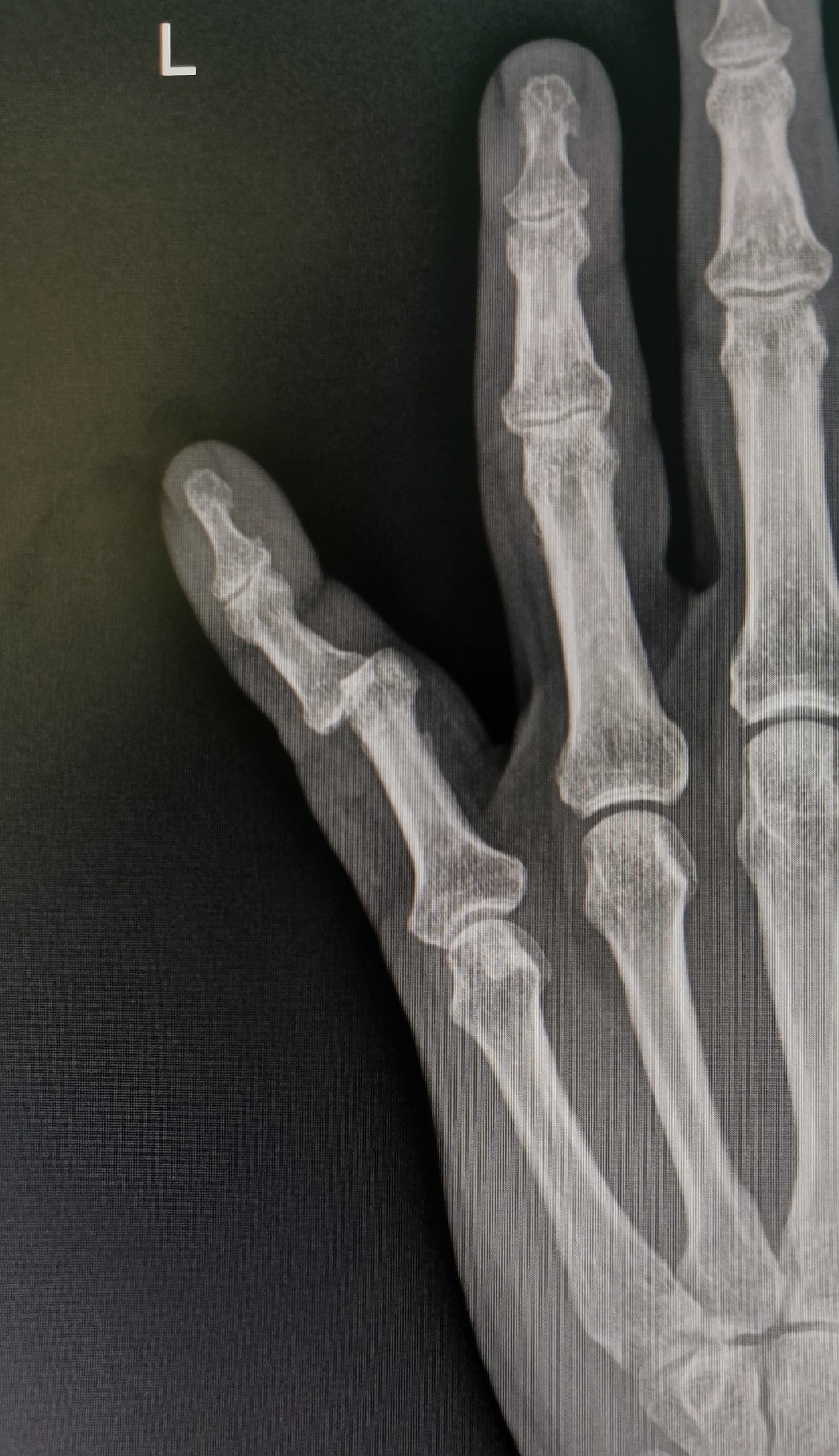 Luxation de doigt - Institut Aquitain De La Main