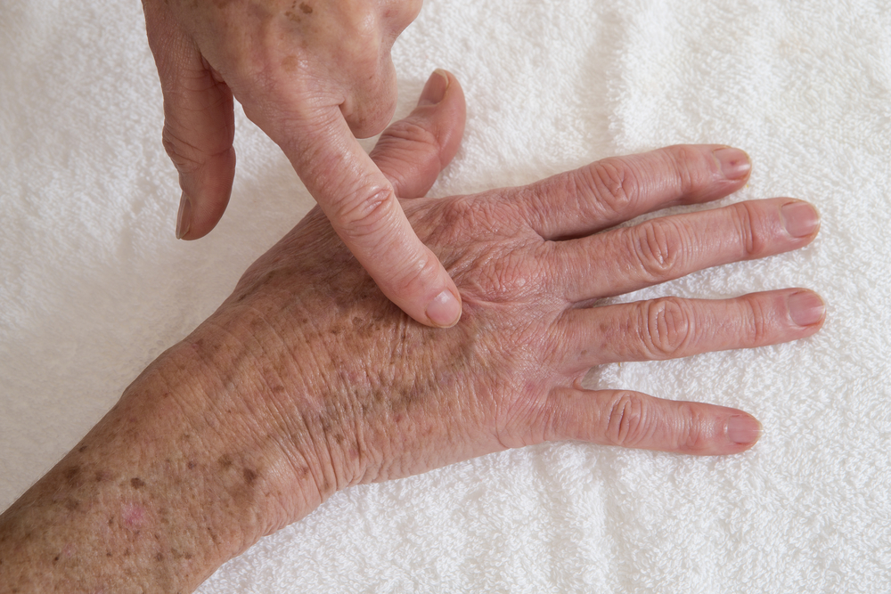 Tumeur de la peau de la main - Institut Aquitain De La Main