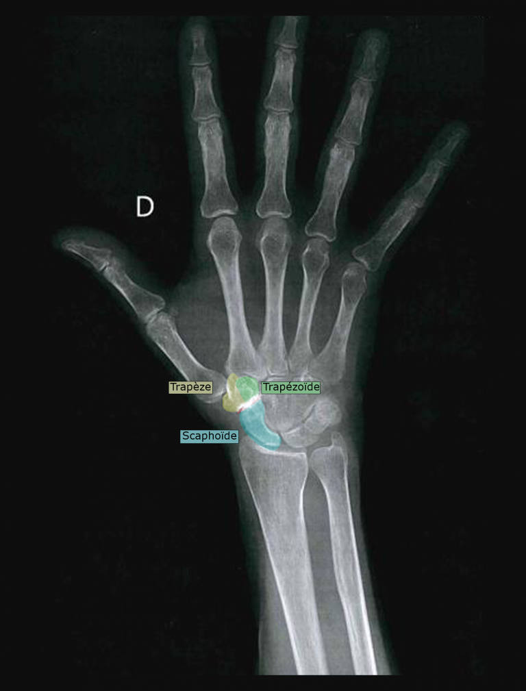 Arthrose STT - Institut Aquitain De La Main
